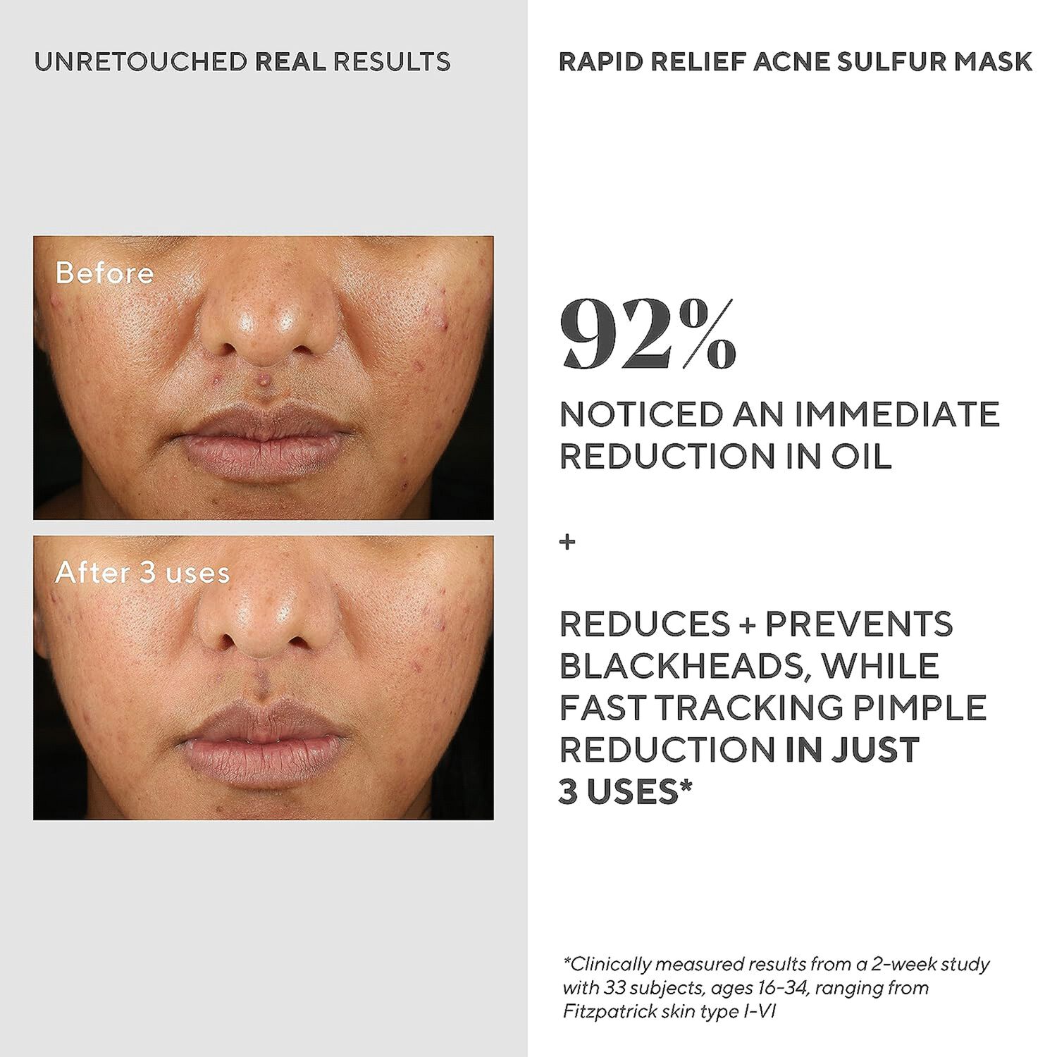 Rapid Relief Acne Sulfur Mask - Murad | CosmoProf