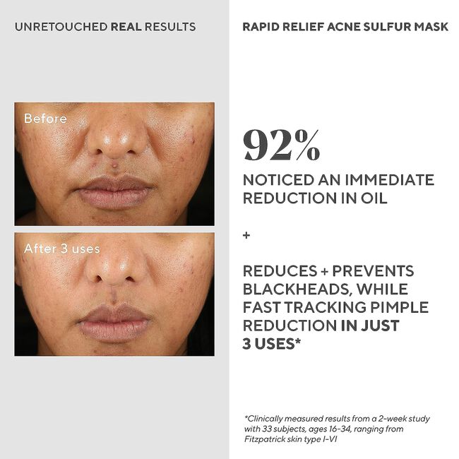 Rapid Relief Acne Sulfur Mask - Murad | CosmoProf